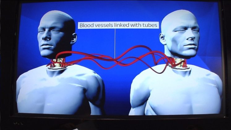 World's First Head Transplant Is Happening, Just 8 Months Left